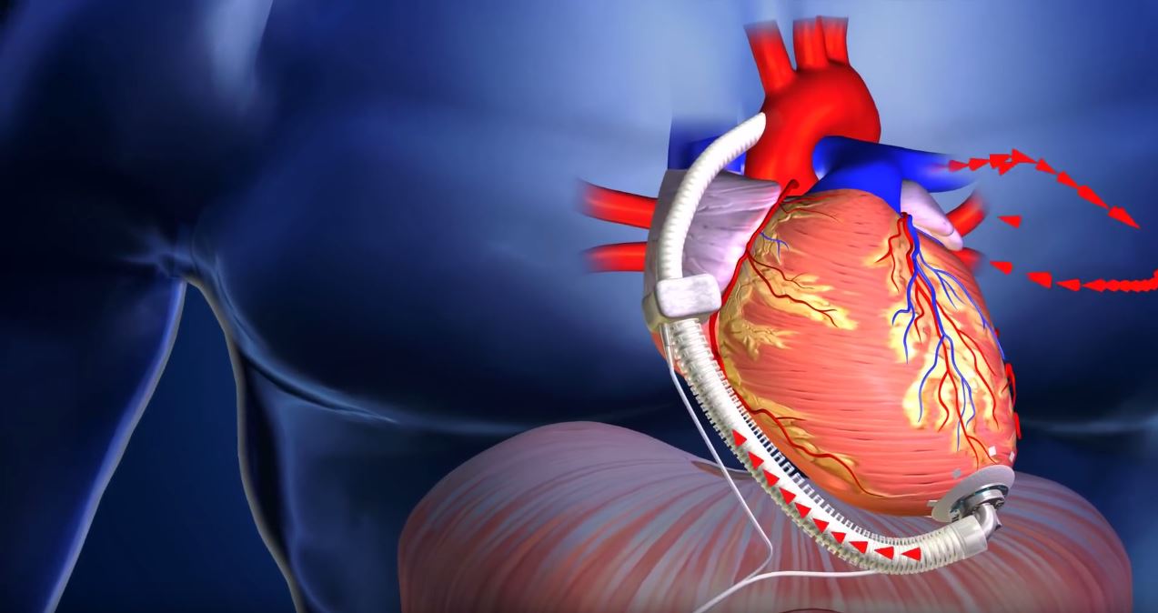 ReliantHeart Announces European Clearance For New LVAD - Medical Design ...