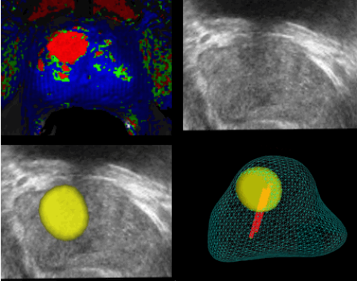 Fusion Targeted Prostate Biopsy Proves More Accurate in Diagnosis of ...