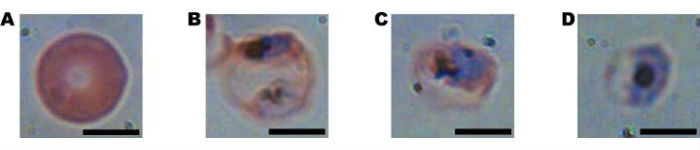Holographic Imaging And Deep Learning Diagnose Malaria - Medical Design ...