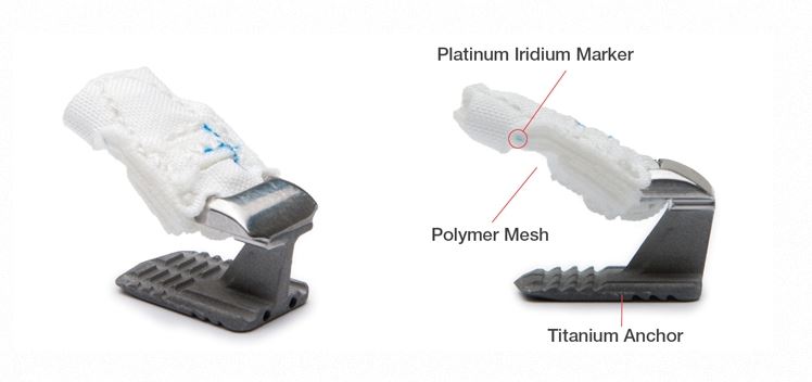 Barricaid Blocks Pain for Herniated Disc Patients - Medical Design and ...
