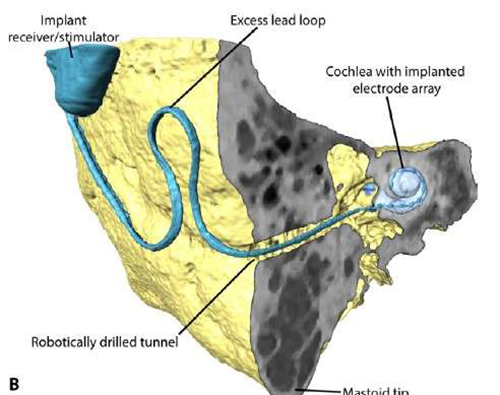 Researchers Develop High-Precision Surgical Robot for Cochlear ...