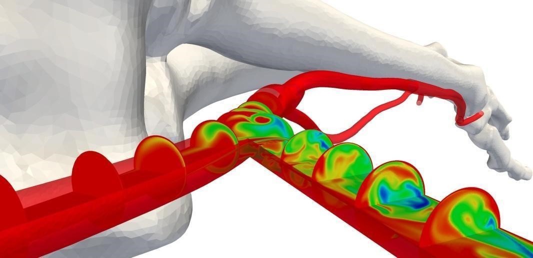 Blood Flow Simulations Bring Safer and Affordable Hemodialysis to the ...