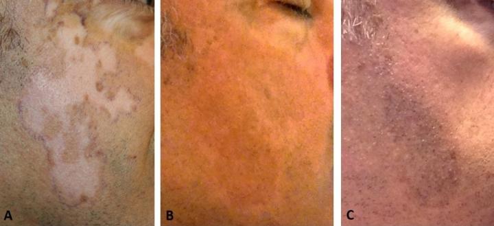 MKTP Surgery Has Long-Term Benefit For Restoring Skin Pigmentation In ...