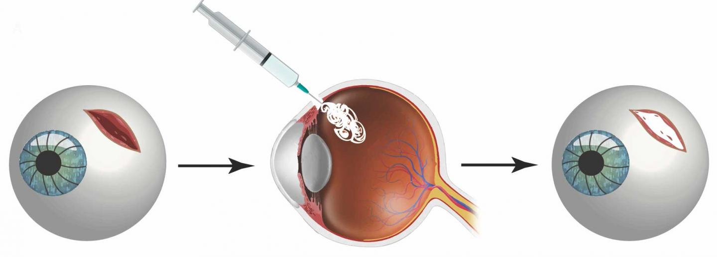 Combating Eye Injuries with a Reversible Superglue Seal - Medical ...