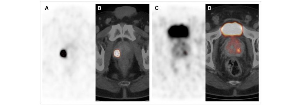 PSMA PET/CT Clearly Differentiates Prostate Cancer From Benign Tissue ...