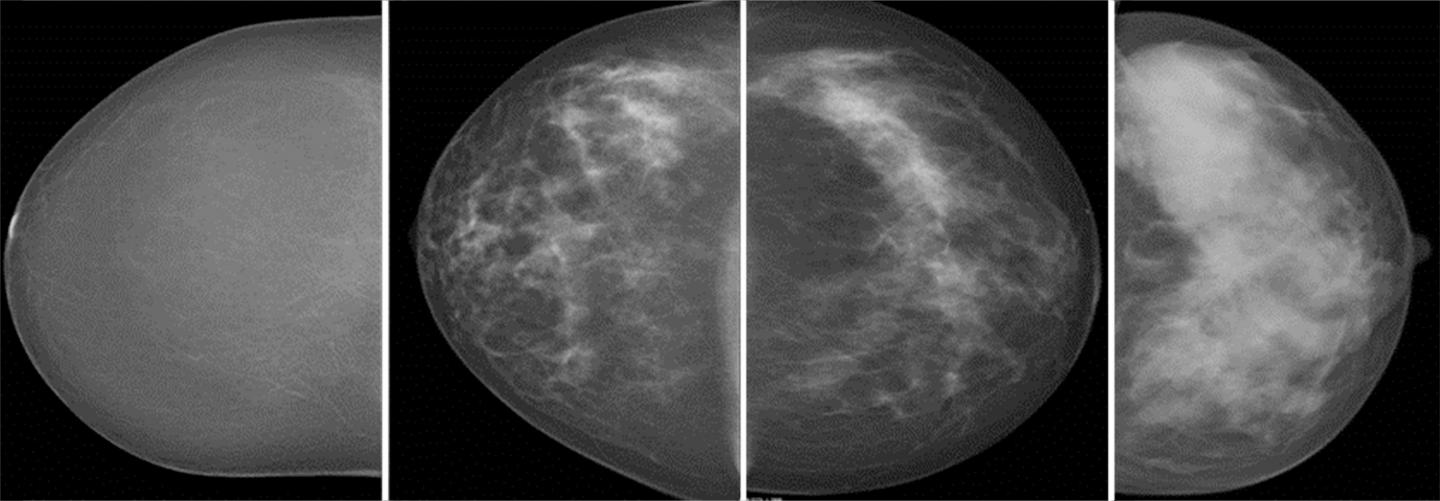 New Study Confirms Higher Cancer Rate In Women With Dense Breast Tissue ...